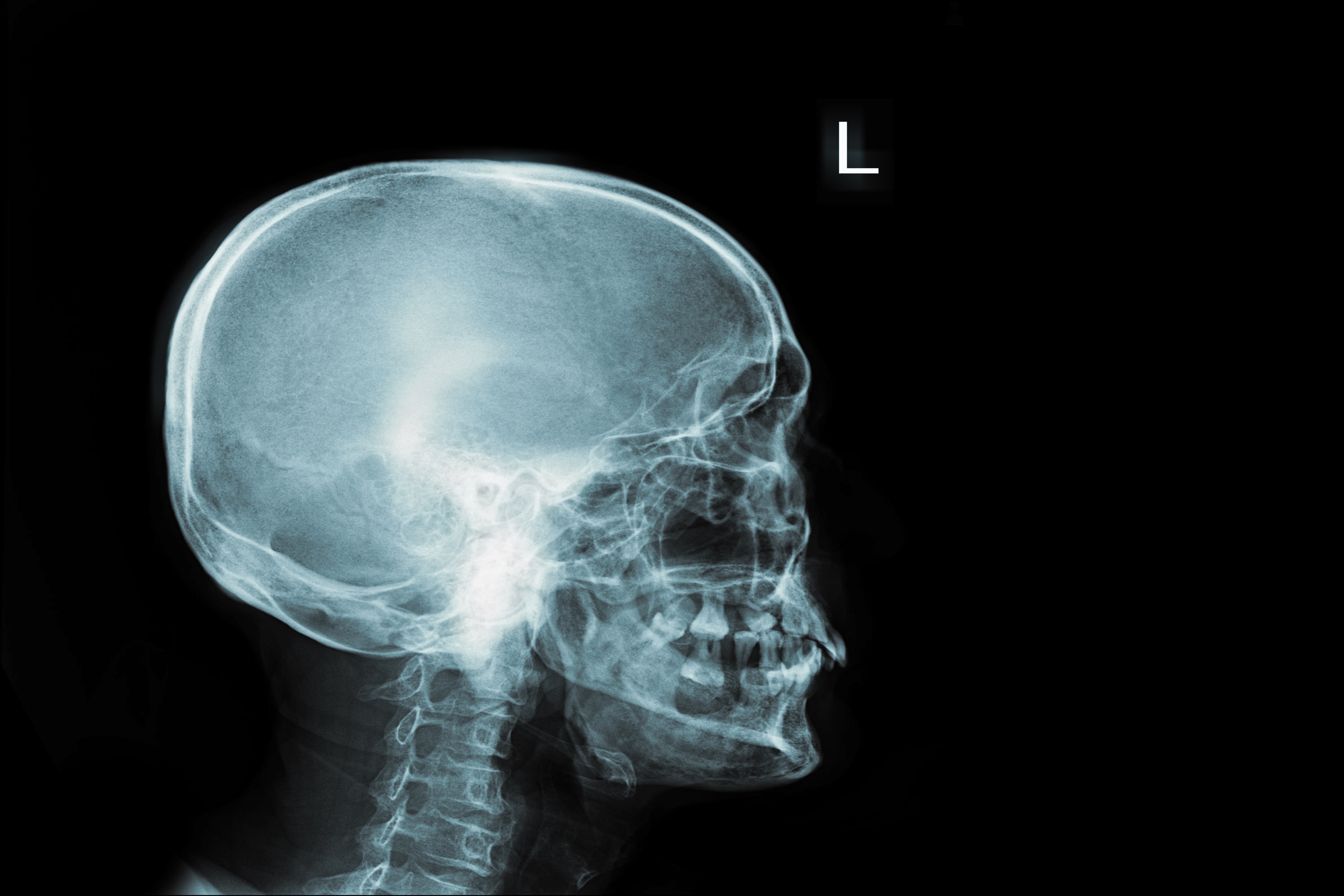 Biomechanical Analysis of Concussion - MEA Forensic